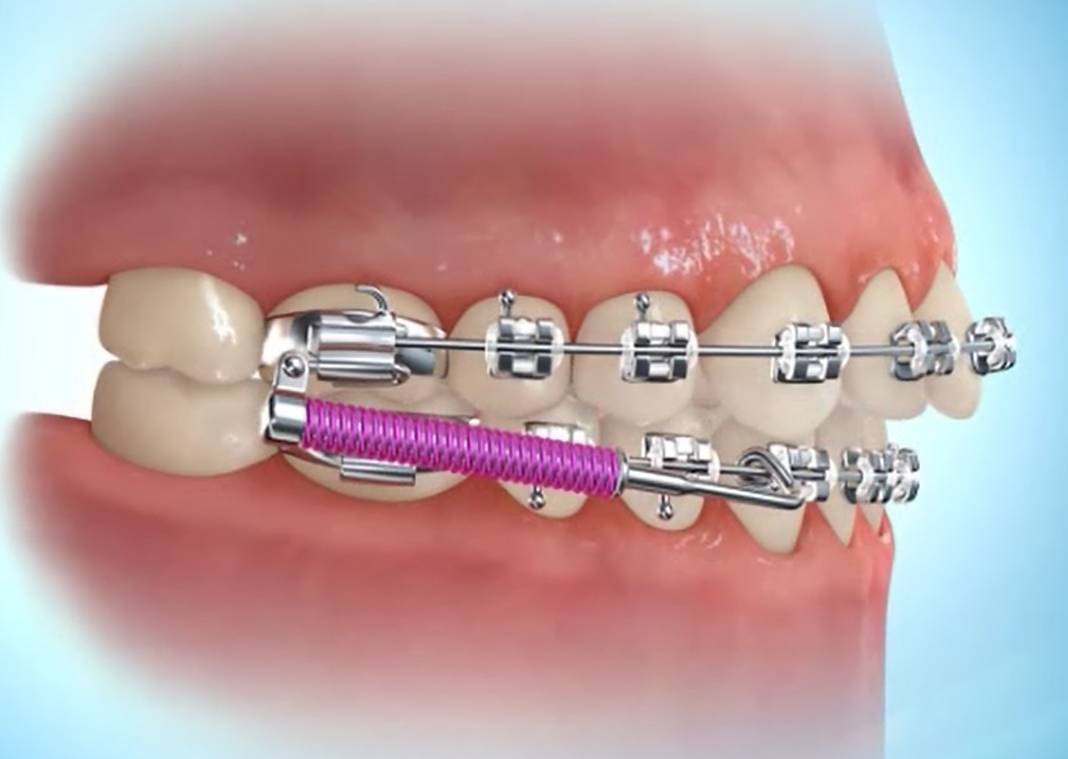 Orthodontic Appliances | Feinstein 360 Orthodontics